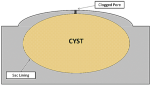 Cysts | Pennsylvania Dermatology Specialists