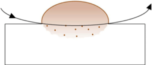 Mole Removal in Southampton, PA | Mole Dermatologists in Southampton ...